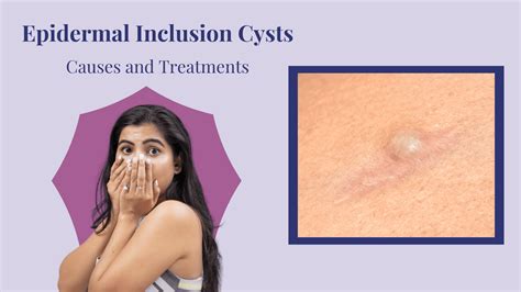 Epidermal Inclusion Cyst