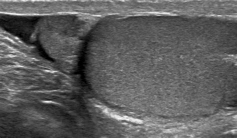 Testicular Appendix Pacs