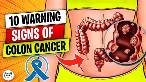 10 Warning Signs Of Colon Cancer You Shouldnt Ignore Youtube