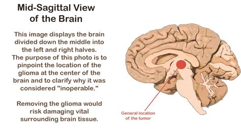 Case Report Diffuse Midline Glioma Male Age 22
