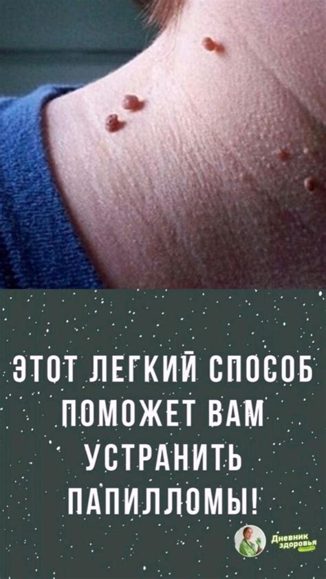 лечение папилом Sağlık Spor