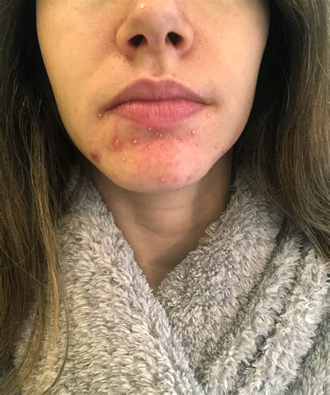 Rosacea On Chin