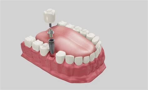 Dental Bridge Vs Partial Dentures Advantages Disadvantages