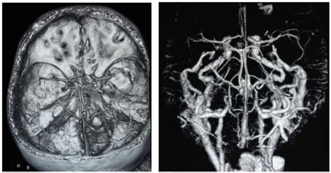 Ct Angiography Showing Left Mca Stenosis Download Scientific Diagram