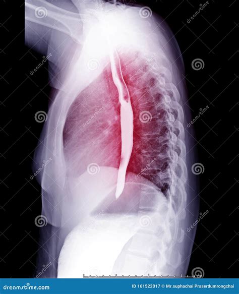 Esophagram Or Barium Swallow Oblique View Showing Esophagus For