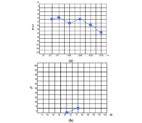Pure Tone Audiometry A And Speech Audiometry B At Last Visit With Download Scientific