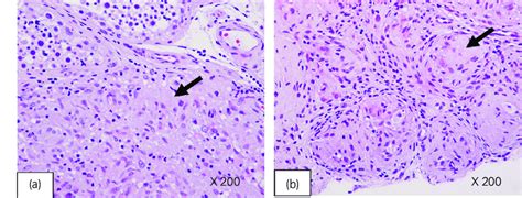 Histopathology Of The Testicular Biopsy Noncaseating Epithelial Cells