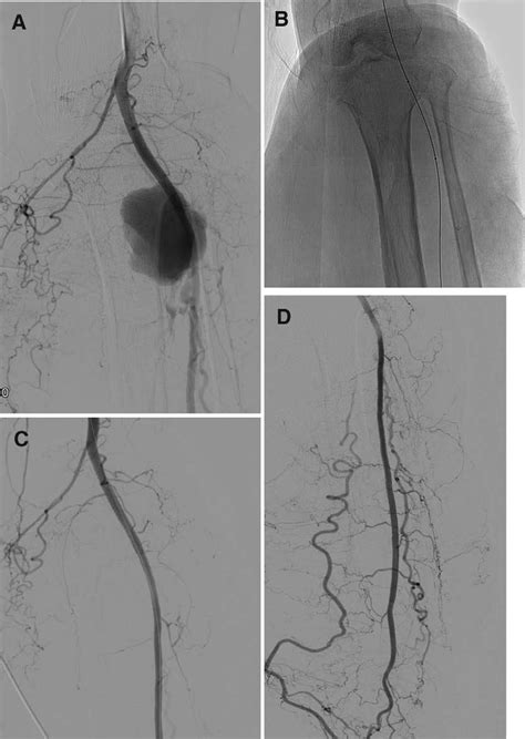 A Left Common Femoral Artery Angiogram Showing Pseudoaneurysm With