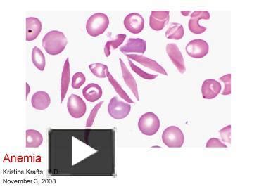 Anemia Presentation Free To View