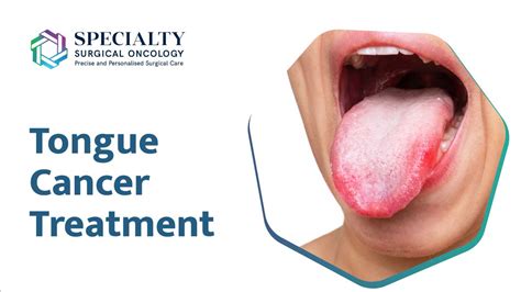 Best Tongue Cancer Treatment In Mumbai Sso Hospitals