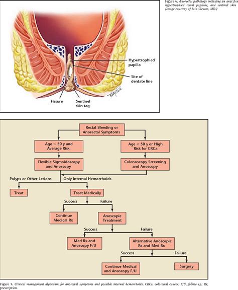 Figure 2 From Definitive Therapy For Internal Hemorrhoids New
