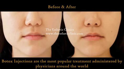 Botox Injection Treatment For Masseter Hypertrophy Jawline Reduction Treatment Dr Debraj