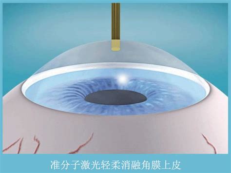 只有单眼近视，也需要戴眼镜吗？ 知乎