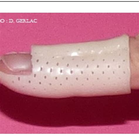 Pdf Comparison Of Custom Made Stack S Splint And Home Made Dorsal