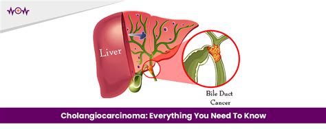 Cholangiocarcinoma Everything You Need To Know Wow Health