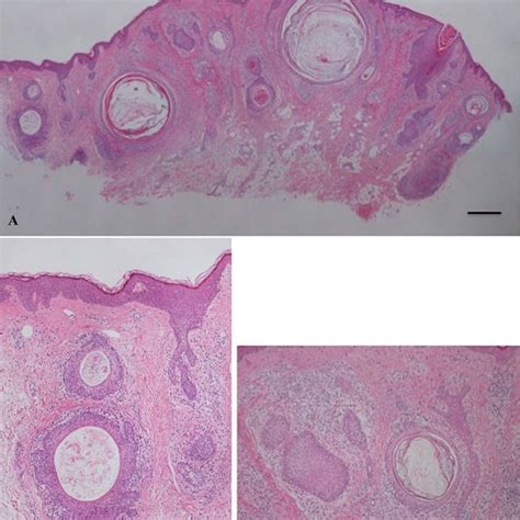 Pdf Milia En Plaque As A Distinct Follicular Hamartoma With Cystic