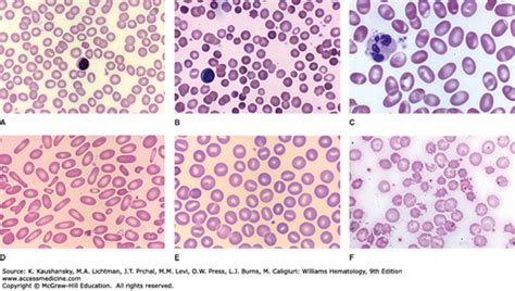 Erythrocyte Membrane Disorders Oncohema Key