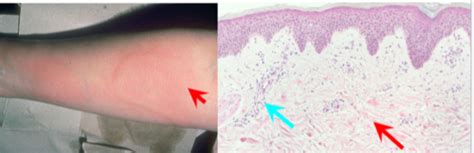Acute Inflammatory And Eczematous Dermatoses Flashcards Quizlet