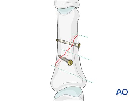 Lag Screw Fixation For Oblique Fracture Of The Diaphysis