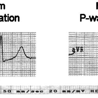 The P Wave Durations Pmax And Pmin Were Calculated In All 12 ECG Leads Download Scientific