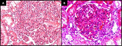 A High Power Light Microscopy View Of A Large Glomerulus With Global