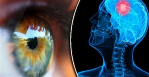 Simptomat E Tumorit Të Trurit 10 Shenja Të Pazakonta Që Mund Të