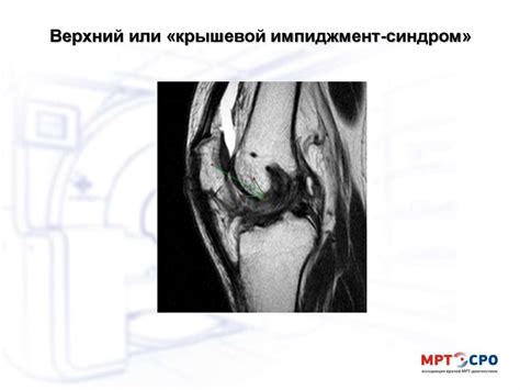 Возможности МРТ визуализации в диагностике послеоперационных осложнений
