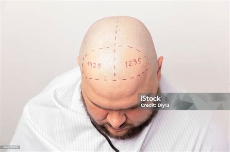 남자의 대머리 전후 머리에 모발 이식 과정 대머리의 치료 35 39세에 대한 스톡 사진 및 기타 이미지 35 39세 건강