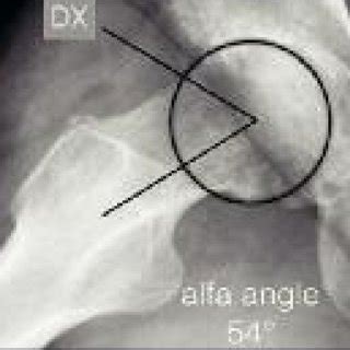 Postoperative Assessment Of Alpha Angle At 6 Months Of Follow Up Download Scientific Diagram
