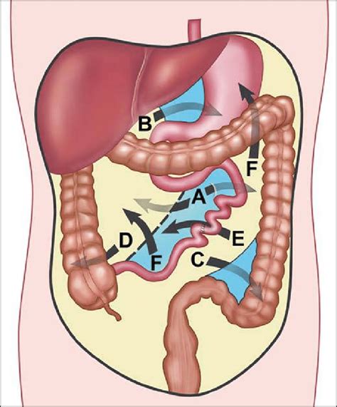 Diagrammatic Illustration Shows Various Types Of Internal Hernias A