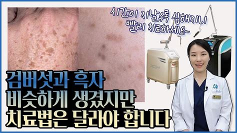 검버섯과 흑자는 없애려면 어떤 레이저 시술을 받아야 할까요 궁금한사람 모두 모여라 Youtube