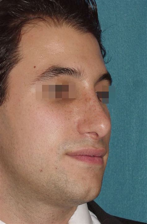 Male Rhinoplasty 24 Robert A Guida Md Pc
