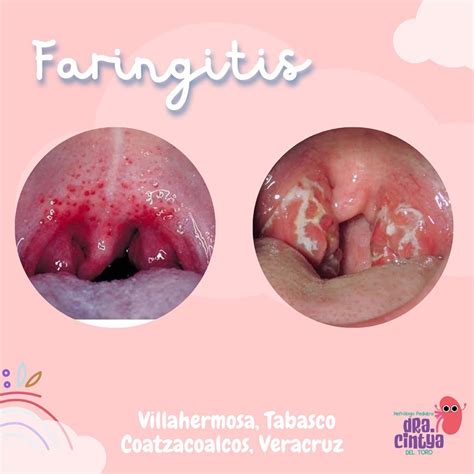 Es La Inflamación Generalmente Debida A Infección De Las Membranas Mucosas De La Garganta