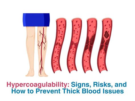 Hypercoagulability Signs Risks And How To Prevent Thick Blood Issues