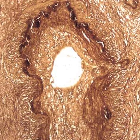 Marked Necrotizing Vasculitis With Fragmentation Of Internal Elastic