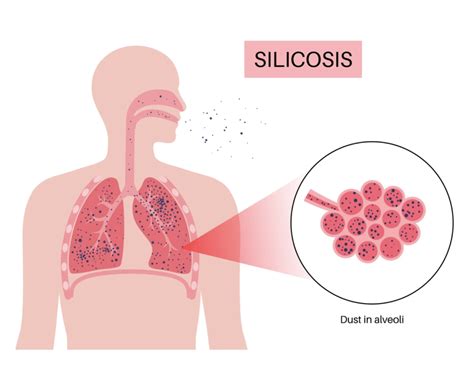 Silicosis Research And Engineered Stone Gards