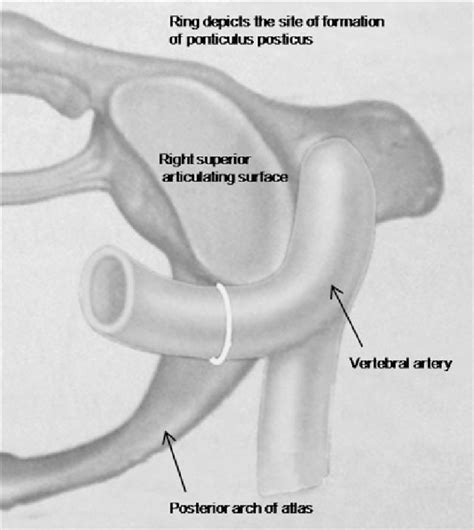 Cranial View Of The Atlas Vertebra Showing The Site Of Formation Of