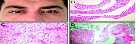 Aneurysmal Bone Cyst Secondary To Ossifying Fibroma In The O