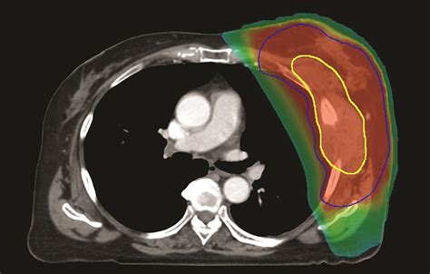 Aggressive Multimodality Therapy For Treatment Of A Locally Advanced