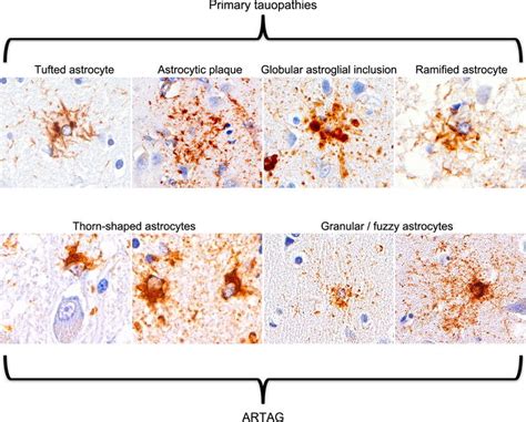 Comparison Of Tau Using At8 Antibody Immunoreactivities Seen In
