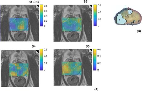 A Multivariate Curve Resolution Analysis Of Multicenter Proton
