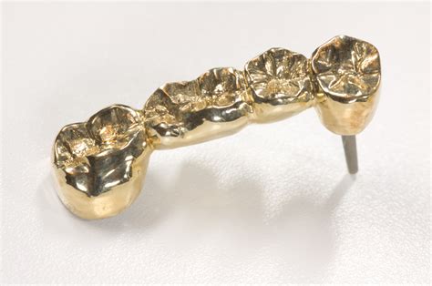 Options For Replacing A Missing Tooth 3