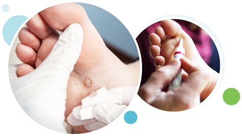 Plantar Wart Removal And Treatement Northstate Fandas Podiatrists