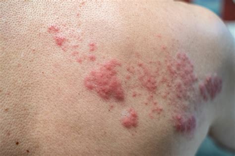 Shingles Signs And Symptoms
