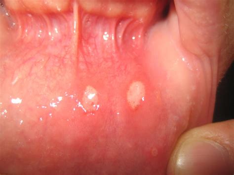 Mouth Ulcer
