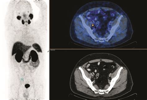 Pet Scan Identifies Which Prostate Cancer Patients Can Benefit From
