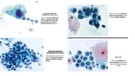 Bethesda Classification Of Cervical Cytology Manya Yadav 1 1pptx