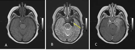 Inflammatory Pseudotumour Of Skull Base Radiology Cases