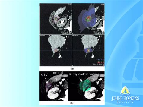 Stereotactic Body Radiation Therapy Ppt