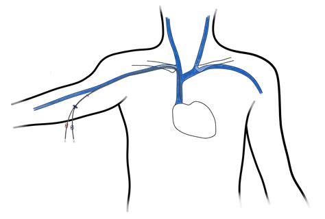 Picc Peripherally Inserted Central Catheter Yorkshire Vascular Access Expert Care For Your